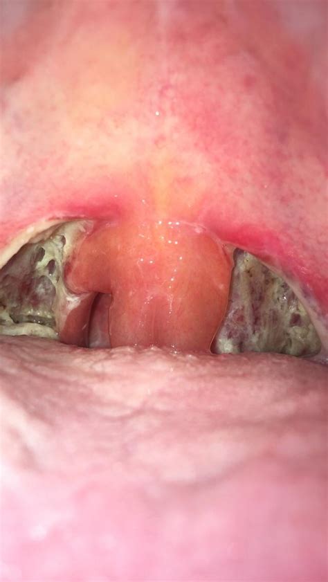 Uvula Swollen After Tonsillectomy Tonsil Hypertrophy Dr Jonathan