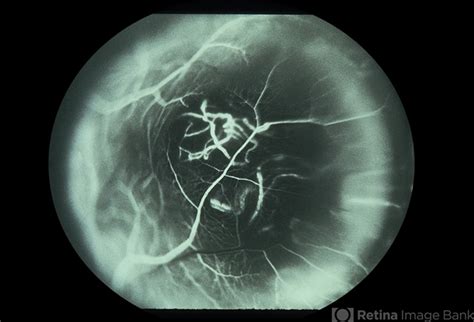 Choroidal Melanoma Retina Image Bank