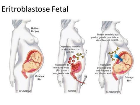 Eritroblastose Fetal Slide Set