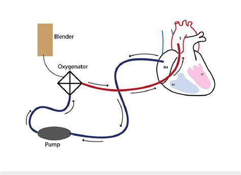 Central Cannulation For Venoarterial Extracorporeal Membrane Download Scientific Diagram