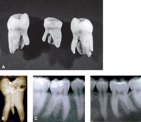 Abnormal Tooth Morphology Pocket Dentistry