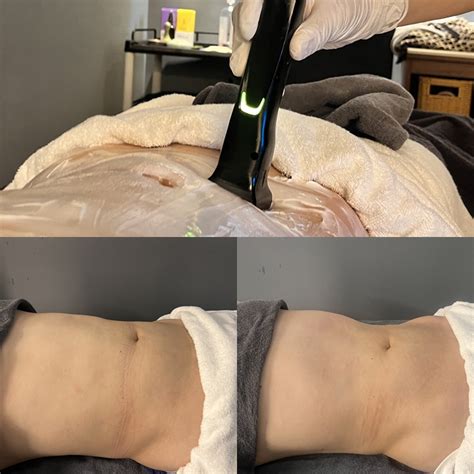 검단피부관리 당하동피부관리 써마젯 고주파 복부관리 제이에스js에스테틱 후기 네이버 블로그
