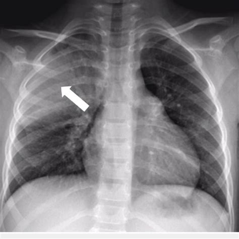 Ultrasound Chest Complex Septated Right Sided Effusion With Associated