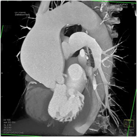 Dilated Ascending Aorta Without Dissection Vascular Radiology Case