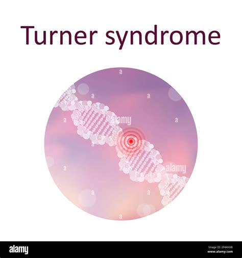 Turner Syndrome Diagram