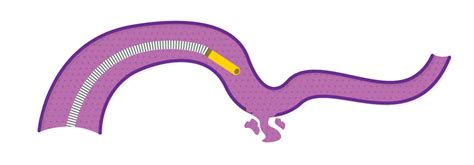 About Obsidio™ Conformable Embolic Boston Scientific