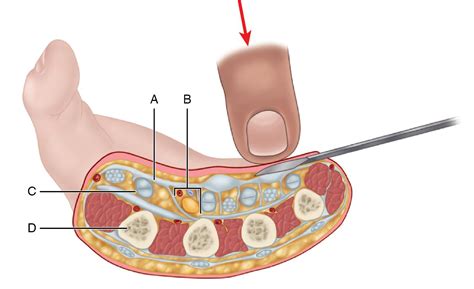 Subcutaneous Fasciotomy Partial Fasciectomy For Dupuytren Contracture Clinical Tree