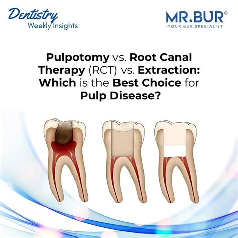 Understanding Dental Pulp Common Diseases Root Canal Therapy And Ad Mr Bur