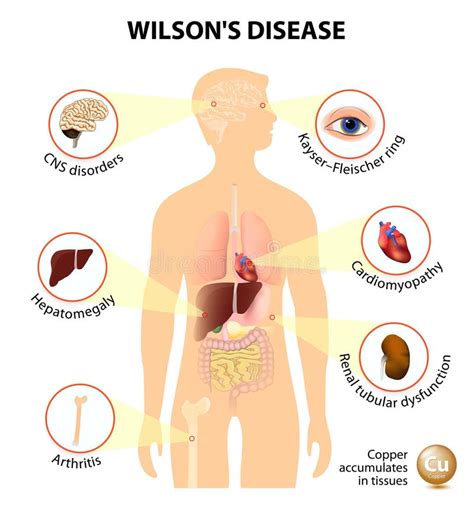Morbus Wilson Vektor Abbildung Illustration Von Hepatitis 54105539