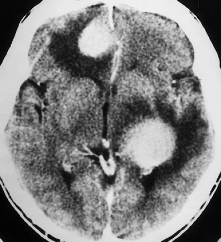 Central Nervous System Infections Radiology Key