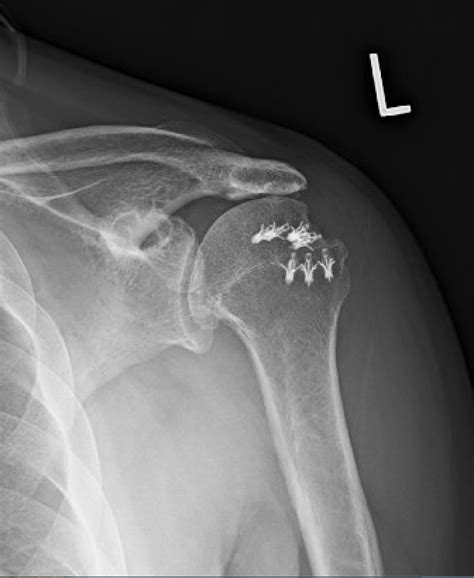 Uw Shoulder And Elbow Academy Reverse Total Shoulder Complication