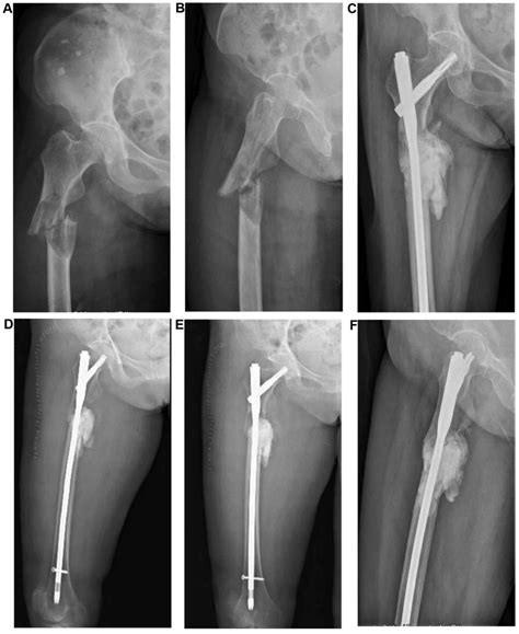 Pathologic Fracture X Ray