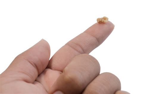 Tonsil Stones Bad Smell Bad Breath — Healthintell