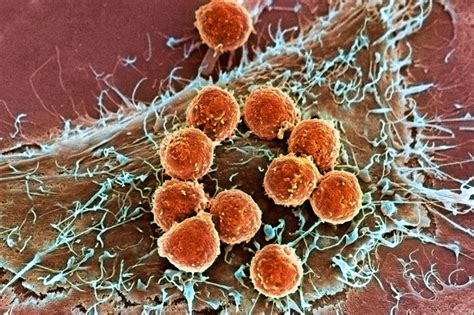 Cancer Cell Under Electron Microscope