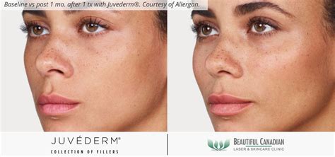 Juvederm Cheekbones