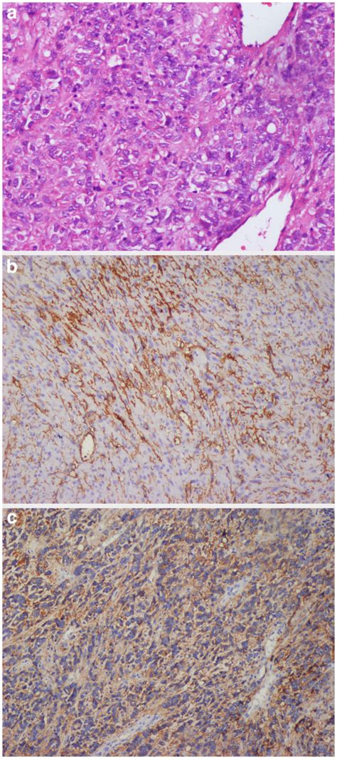 Extragastrointestinal Stromal Tumor Of The Mesoappendix Ct Findings And A Review Of The
