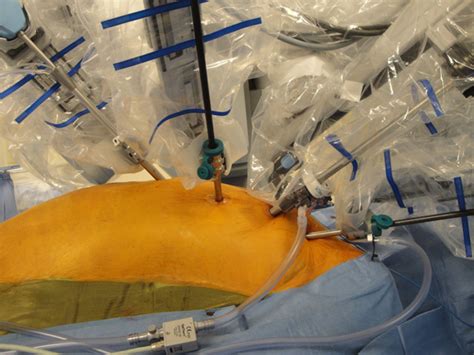 Pericardial Window Procedure Steps