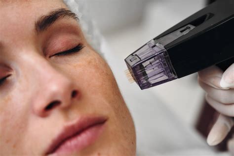 Microneedling In Las Vegas Nv Silk Skin Laser Spa