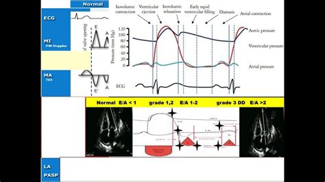 1 Test Your Skill Diastolic Dysfunction Simplified Echo Parameters And