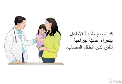 مُعالجةُ الفَتق السرِّي عندَ الأطفال