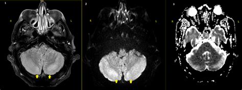 Brain Mri 1 Hyperintensity Is Observed On T2 Flair Sequences In The Download Scientific