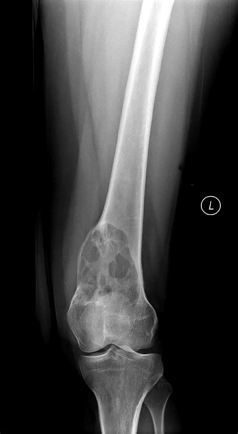 Giant Cell Tumor Mri