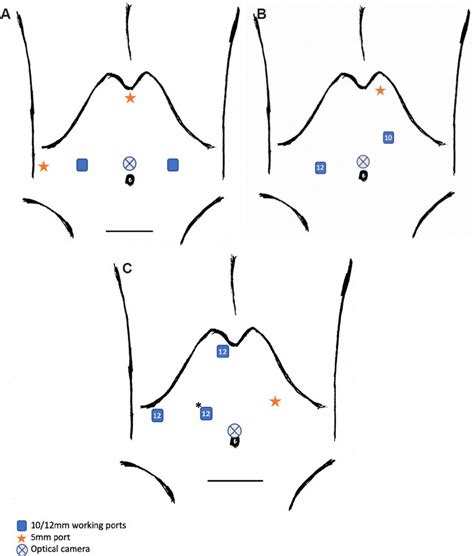 Laparoscopic Left Lateral Sectionectomy Common Port Placement