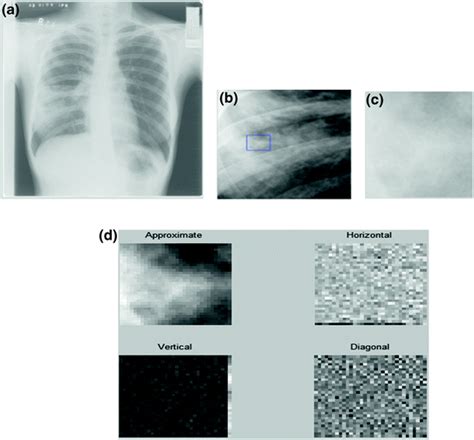 Texture Based Statistical Detection And Discrimination Of Some Respiratory Diseases Using Chest