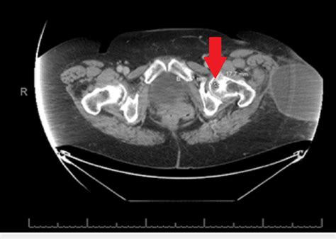 Lytic Lesion Of The Left Femoral Head Via Computerized Tomography A Download Scientific Diagram