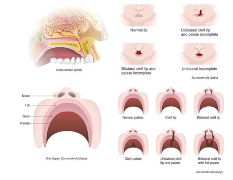 Types Of Cleft Lip And Palate Disorders Icd 10
