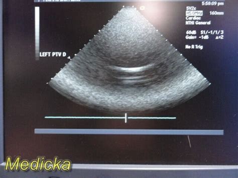Used Acuson 5v2c Vector Array Model 08260629 ~ Ultrasound Transducer For Sale Dotmed
