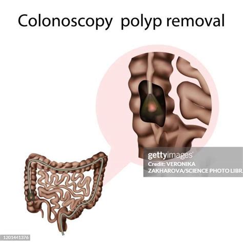 Colonoscopy Polyp Photos And Premium High Res Pictures Getty Images