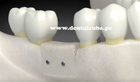 Injerto óseo En Bloque Para Implantes Dentales Dental Cuba