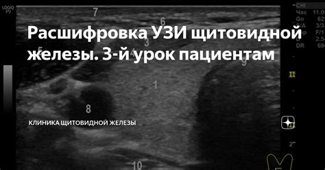 Расшифровка УЗИ щитовидной железы 3 й урок пациентам Клиника щитовидной железы Дзен