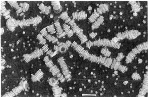 Electron Micrograph Of Hdl In A Patient With Lcatdeficien~y