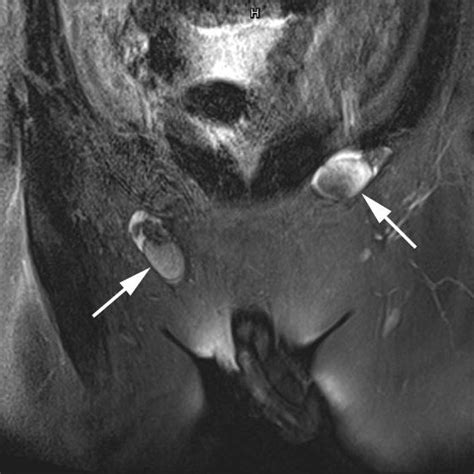 A 25 Year Old Male With Bilateral Varicocele While The Lesion On The