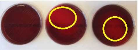 Optimising The Use Of Otowicks In Otitis Externa The Journal Of
