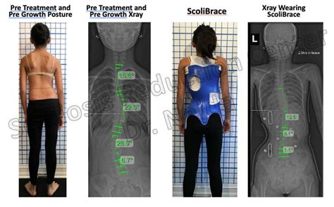 Scoliosis Report Of Findings Scoliosis Reduction Center®