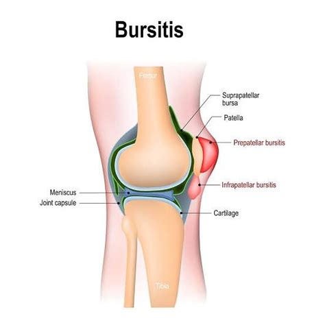 Ezekiel Oburu On Instagram 📌 Clergymans Knee Infrapatellar Bursitis
