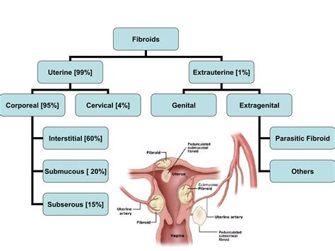 Uterine Fibroidsppt