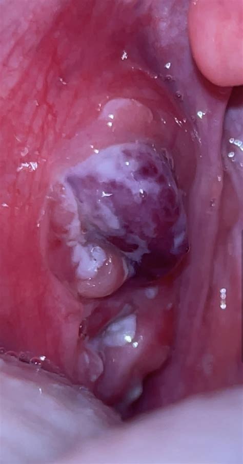 Help What Is This On My Tonsil R Medical Advice