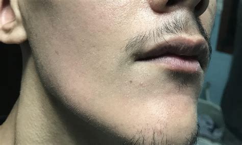 Skin Concern Ive Been Getting These White Patches Almost Daily For