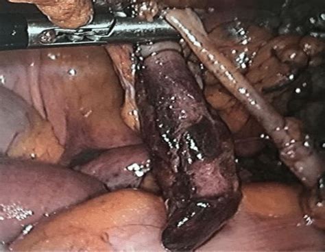 Appendix Was Classified With Perforation In Its Structure Without Download Scientific Diagram