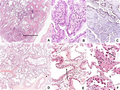 The Role Of Histology In Idiopathic Pulmonary Fibrosis An Update