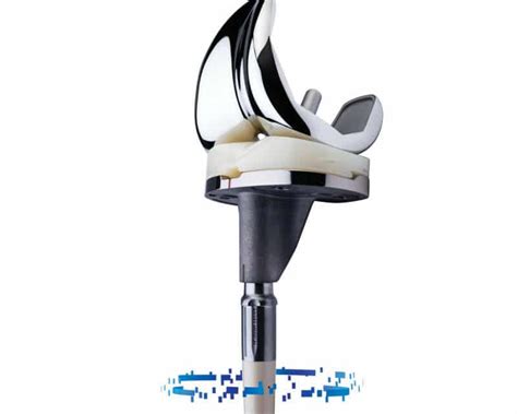 Atlantic Health System Offering Persona Iq Smart Knee Implant For Tka