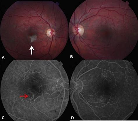 The Pulseless Patient Profound Vasculopathy As The Presenting Feature