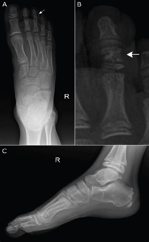 Incidental Detection Of Bilateral Tarsal 3rd Middle Phalangeal