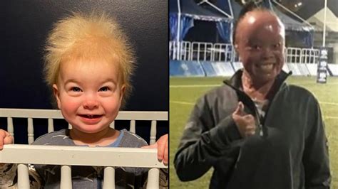Uncombable Hair Syndrome And Other Rare Genetic Conditions Inside Edition