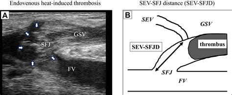 The Proximity Of The Superficial Epigastric Vein To The Saphenofemoral