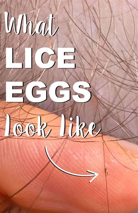 What Lice Eggs Look Like 9 Simple Tricks To Spot Nits Lice Eggs